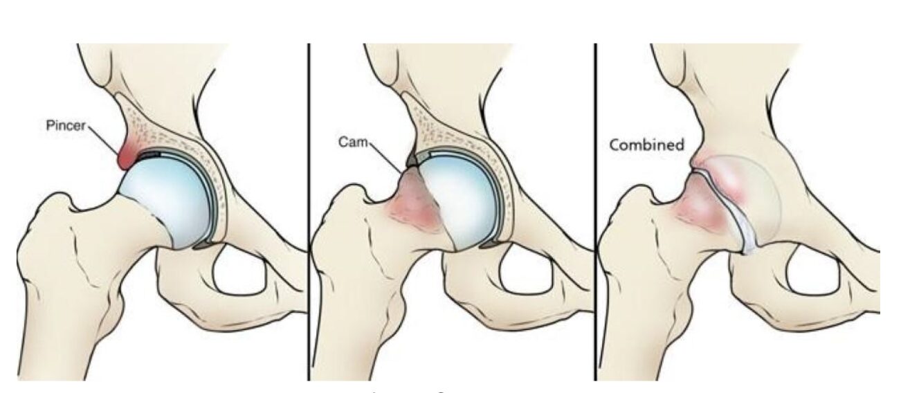 HIP PAIN UNDERSTANDING FEMORAL ACETABULAR IMPINGEMENT Pakenham